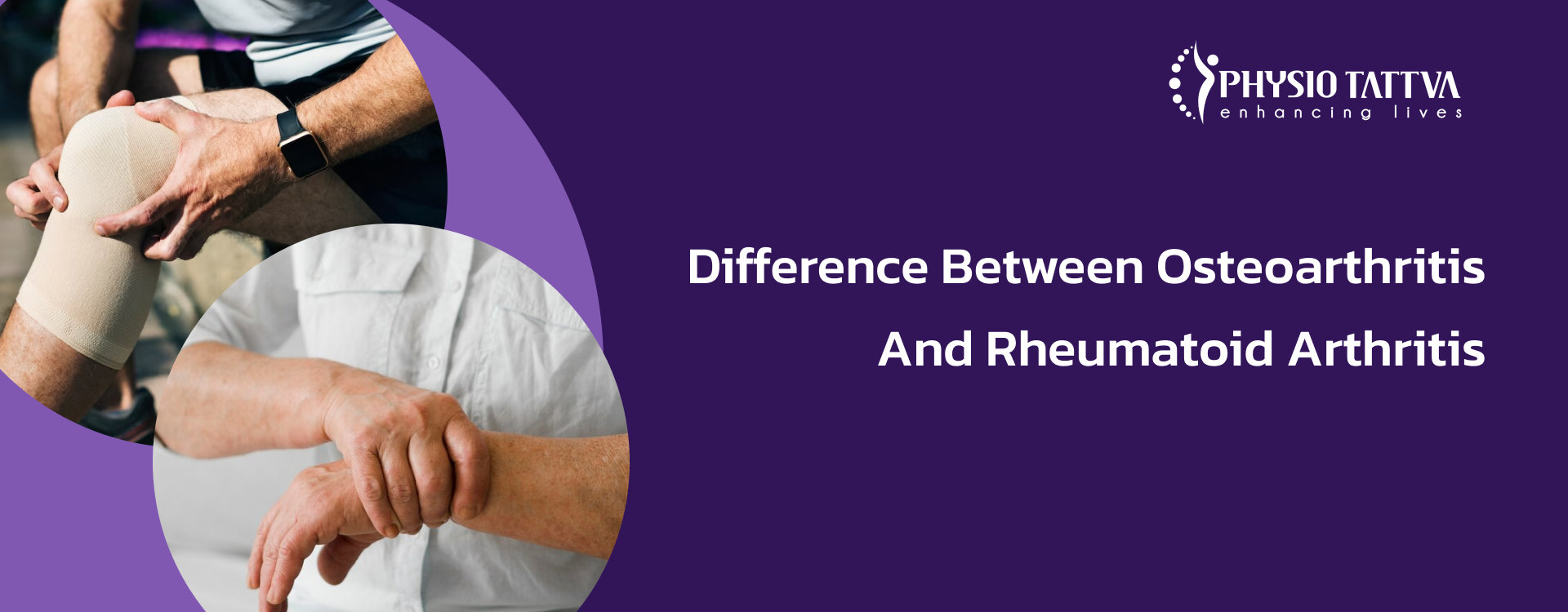 Osteoarthritis Vs Rheumatoid Arthritis Hands